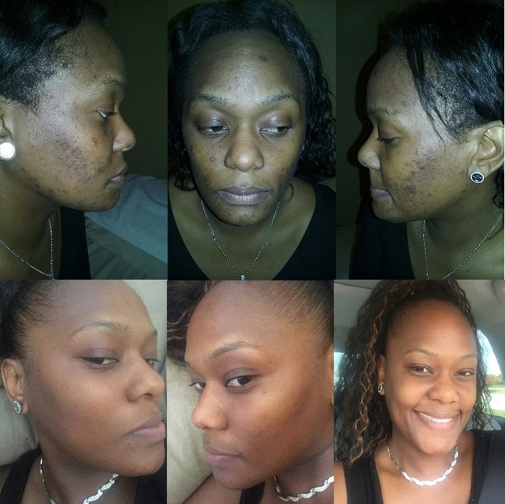 Clear Skin Studio, Examples, The Best Way to Do Acne Treatments ...